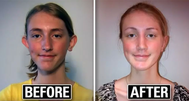 Can Plastic Surgery Help Overcome Bullying Harley St Aesthetics
